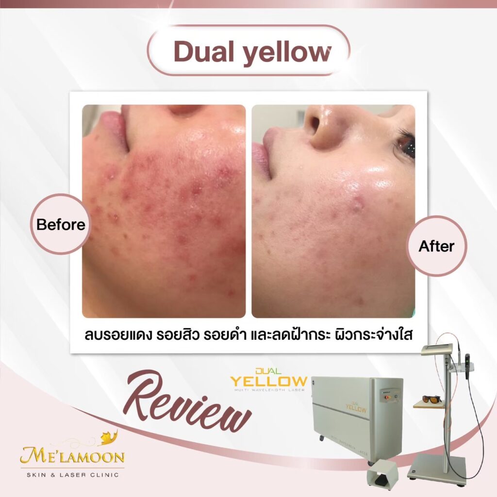 Pico Laser | ลดรอยสิว ลดรอยดำสิว | Dual Yellow Laser