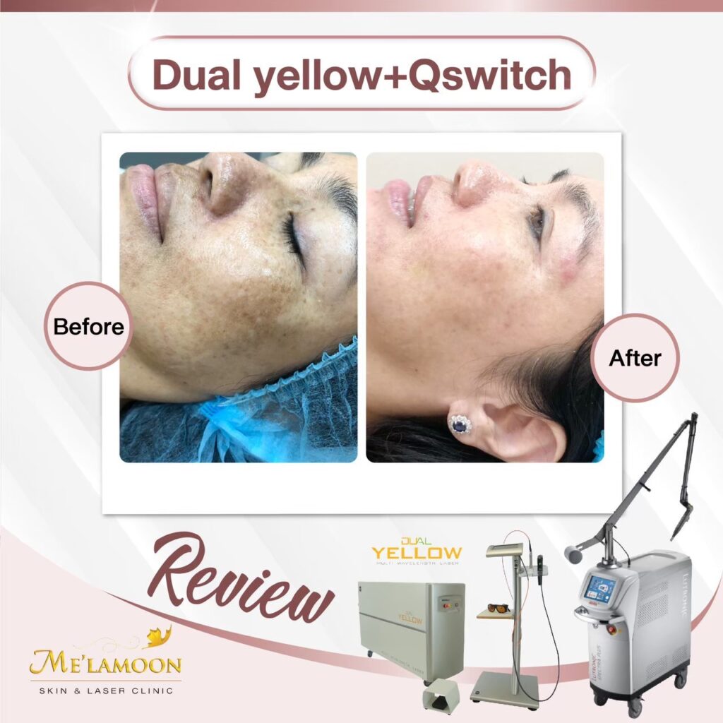 Pico Laser | ลดรอยสิว ลดรอยดำสิว | Dual Yellow Laser