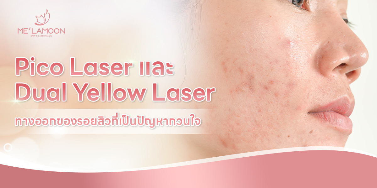 Pico Laser และ Dual Yellow Laser ทางออกของรอยสิว